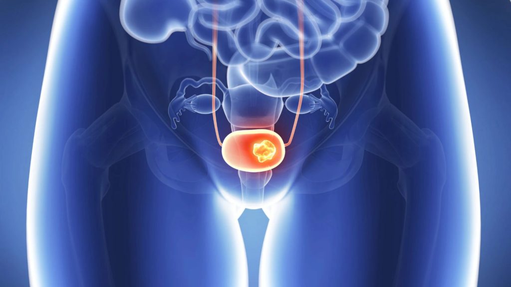 Understanding the early signs of bladder cancer and how new treatment ...